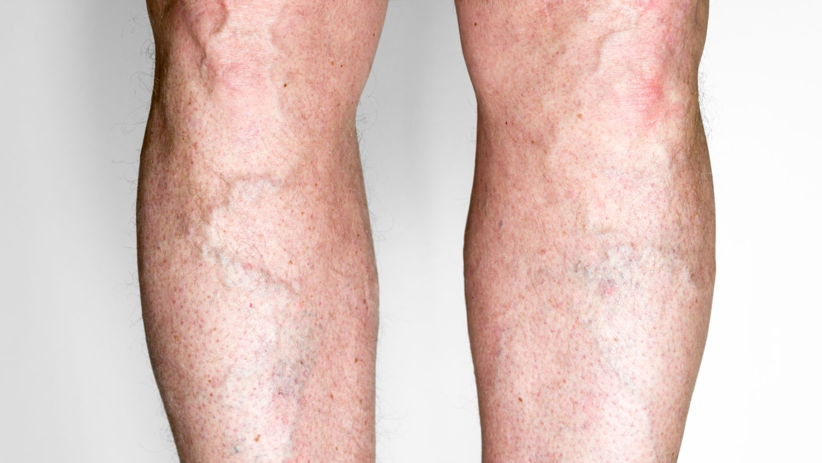 Seven Essential Tips for Maintaining Healthy Veins in a Fast-Paced ...